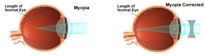 How does your eyes work? Long-Sightedness | Short-Sightedness